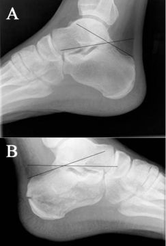 Foot and toe fractures - WikEM