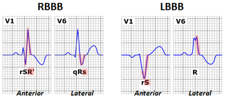 Right bundle branch block - WikEM