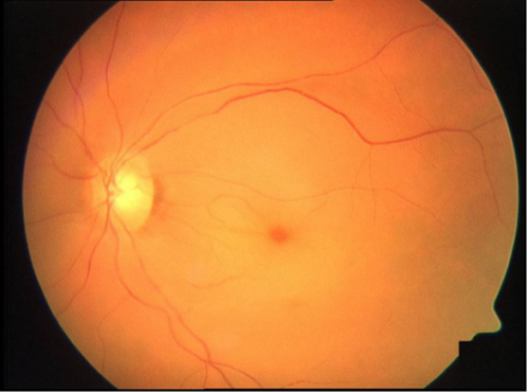 Acute vision loss (noninflamed) - WikEM