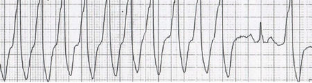 Rhythm diagnosis in regular wide complex tachycardia - WikEM