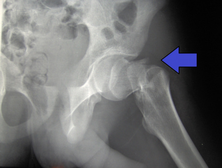 Femur fracture - WikEM