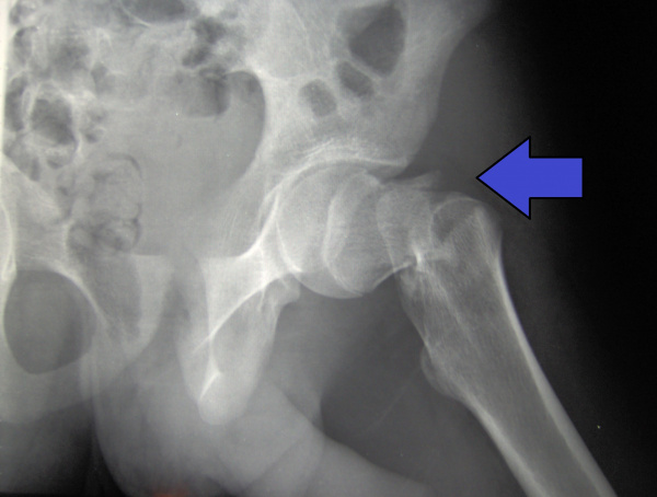 Intertrochanteric femur fracture - WikEM