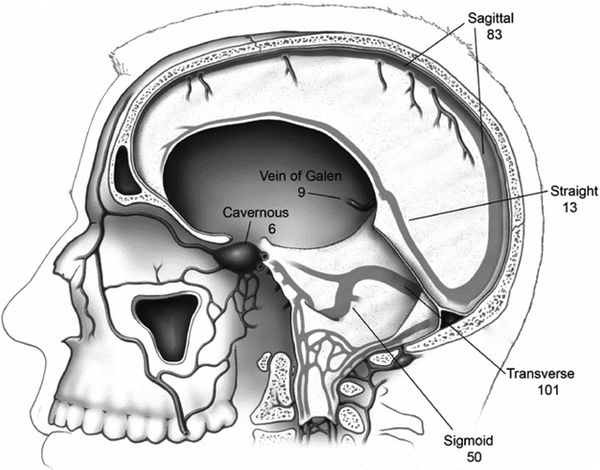 Cerebral venous thrombosis - WikEM
