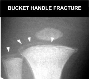 Bucket Handle Fracture