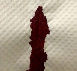 Methemoglobinemia - WikEM