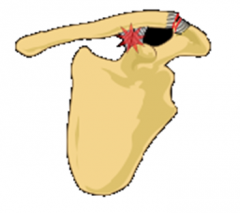 Acromioclavicular joint injury - WikEM