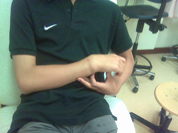 Colles' fracture - WikEM