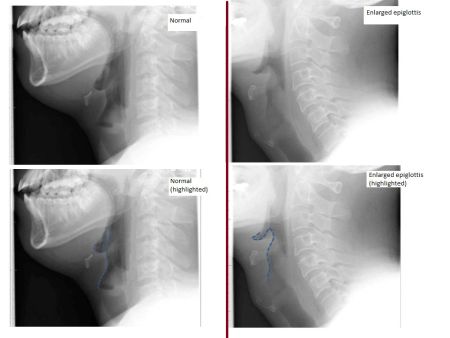 Epiglottitis - WikEM