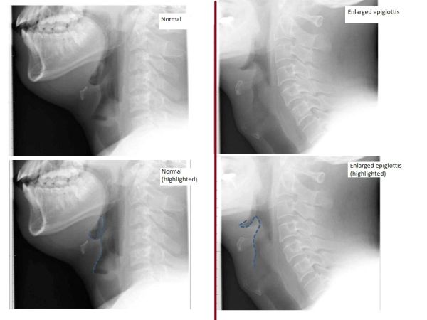 Epiglottitis - WikEM