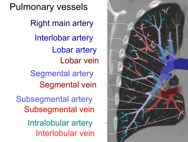 Pulmonary embolism - WikEM