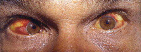 Leptospirosis - WikEM