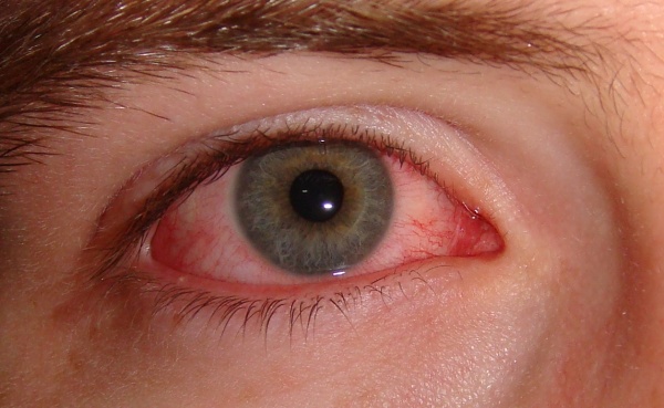 Viral conjunctivitis - WikEM