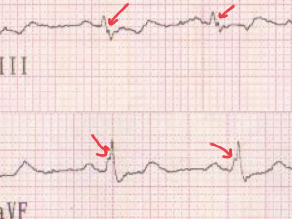 Atrial septal defect - WikEM