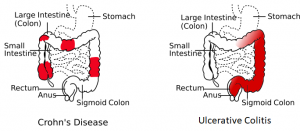 Ulcerative colitis - WikEM
