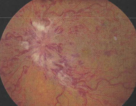 Central retinal vein occlusion - WikEM