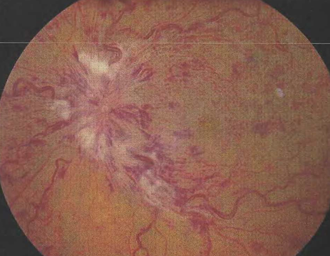 Acute vision loss (noninflamed) - WikEM