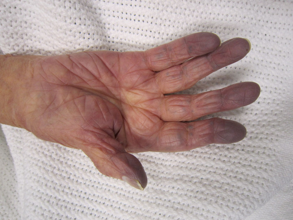 Cyanosis Wikem