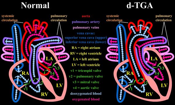 Transposition of the great arteries - WikEM