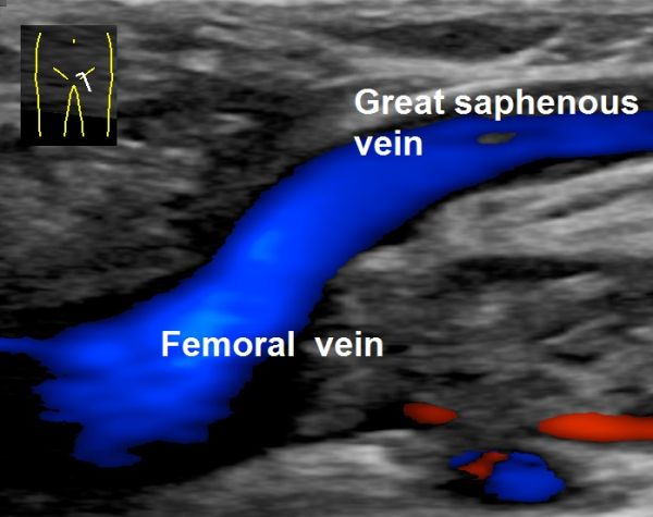 DVT ultrasound - WikEM