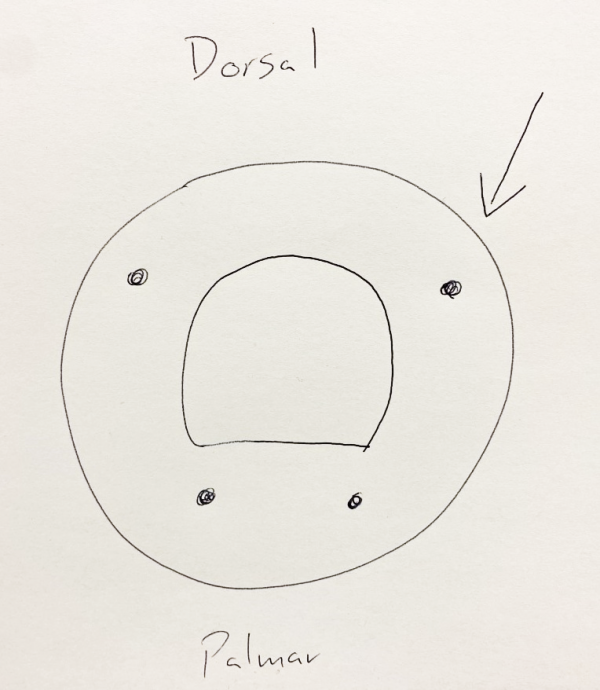 Nerve block: digital block - WikEM