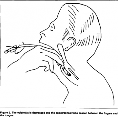 Blind digital intubation - WikEM