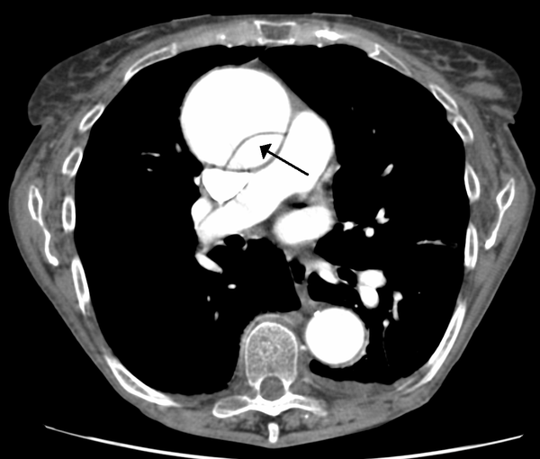 Nontraumatic thoracic aortic dissection - WikEM
