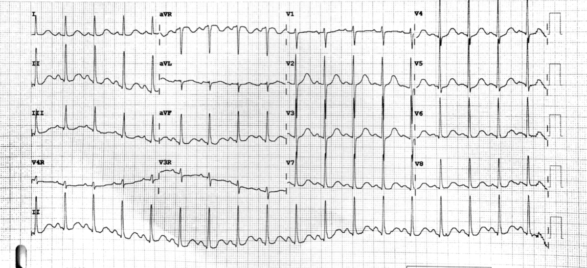 File:ECG.png - WikEM