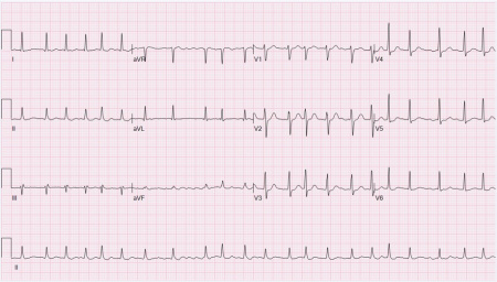 Atrial fibrillation (main) - WikEM