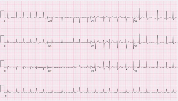 Atrial fibrillation (main) - WikEM