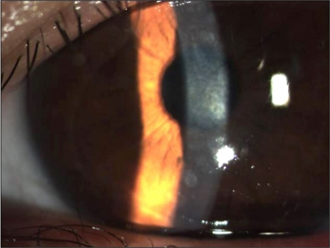 Conjunctivitis - WikEM