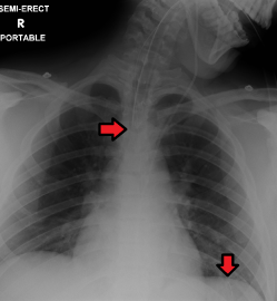 Chest x-ray interpretation - WikEM