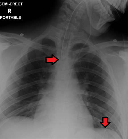 Nasogastric tube placement - WikEM