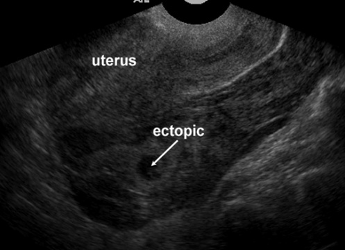 Ultrasound: Pelvic - WikEM