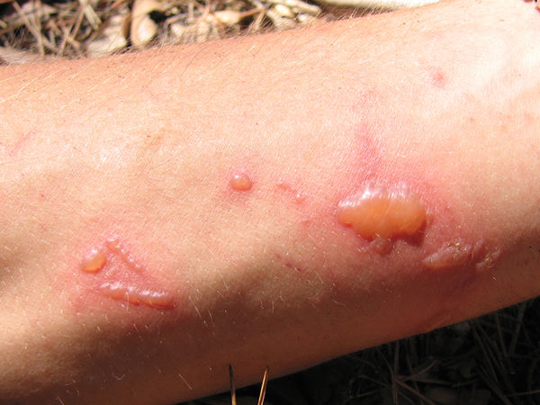 Phytophotodermatitis - WikEM