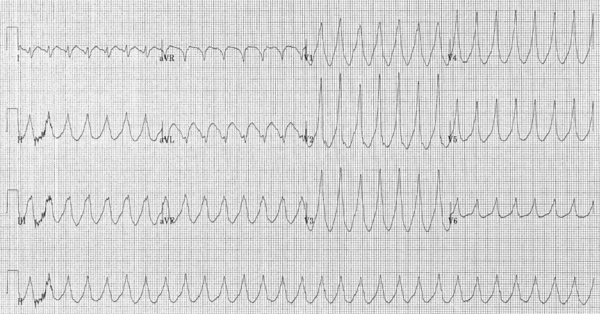 Wide-complex tachycardia - WikEM