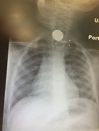 Chest x-ray interpretation - WikEM