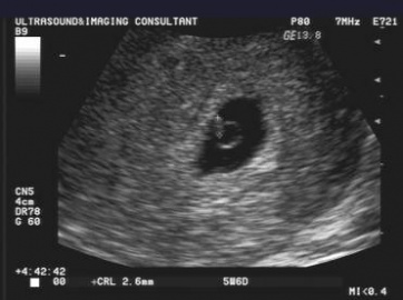 Pelvic ultrasound (transvaginal) - WikEM