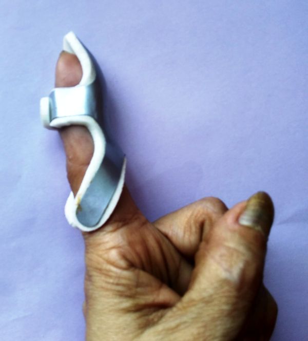 Finger splint - WikEM