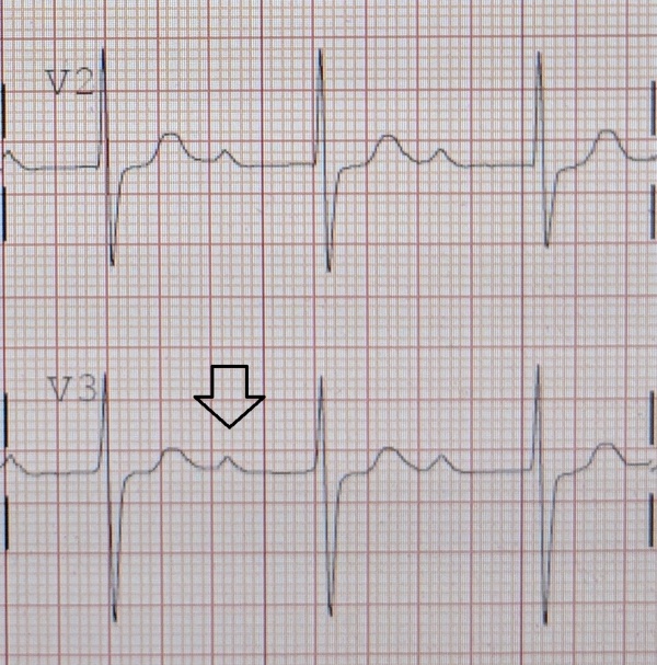 First degree AV block - WikEM