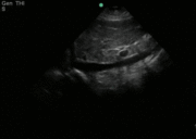 IVC ultrasound - WikEM