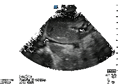 IVC ultrasound - WikEM