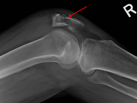 Patella fracture - WikEM