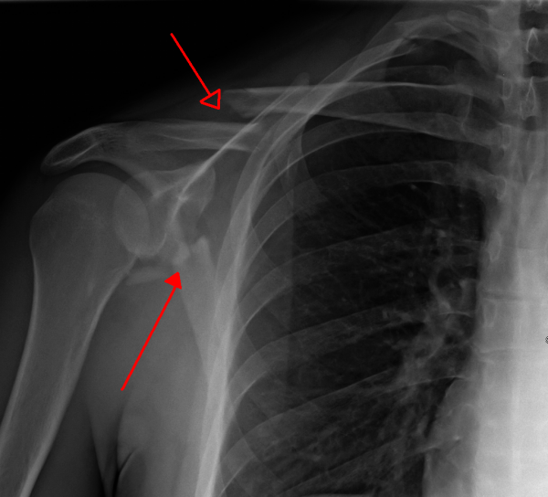 Scapular fracture - WikEM