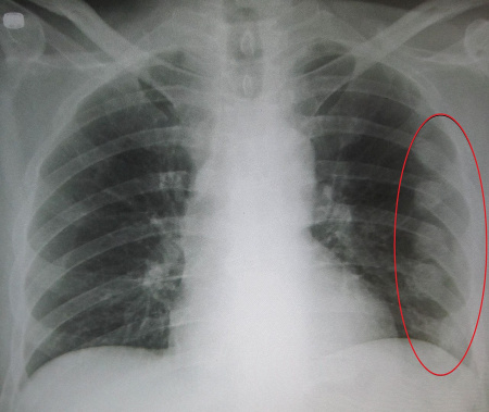 Rib fracture - WikEM