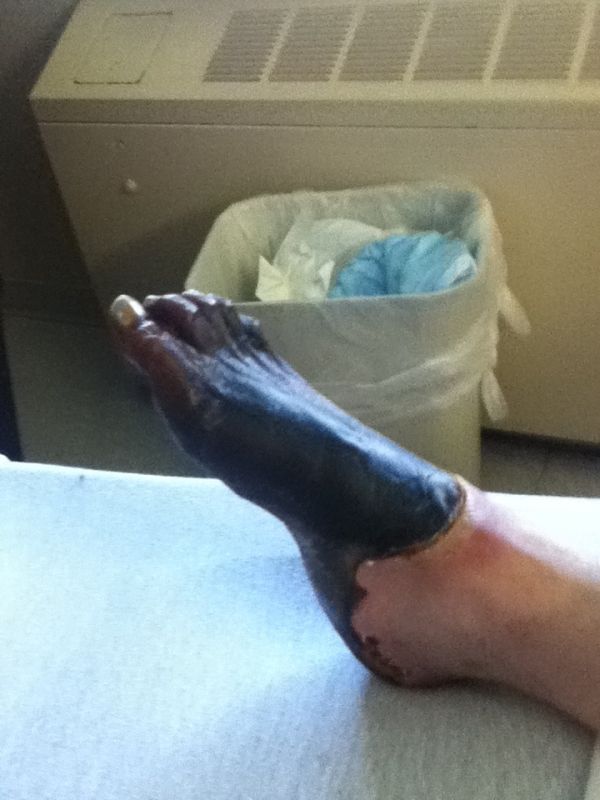 Dry gangrene - WikEM