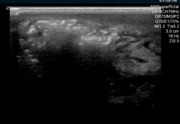 Ultrasound: Soft tissue - WikEM