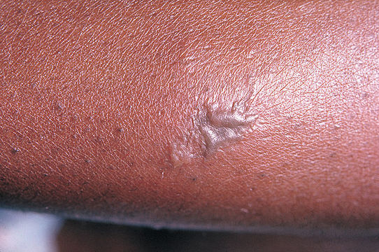 Vesiculobullous rashes - WikEM