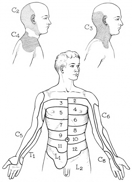 Cervical radiculopathy - WikEM