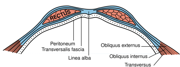 Paracentesis - WikEM
