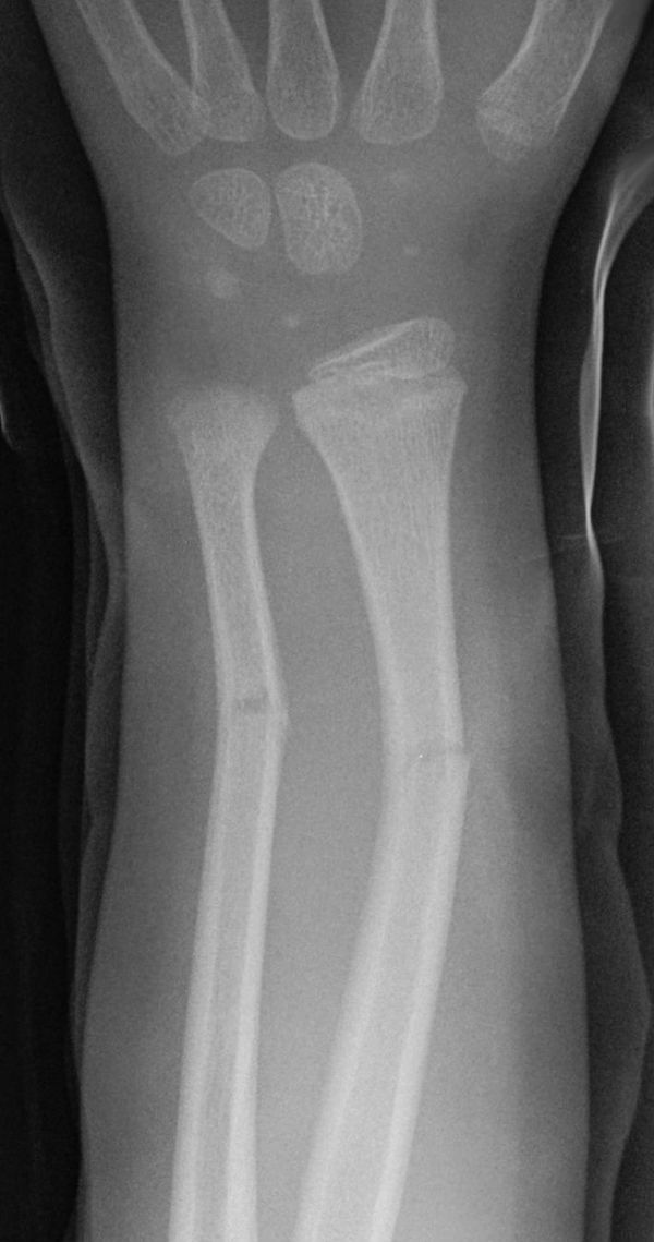 Greenstick fracture - WikEM